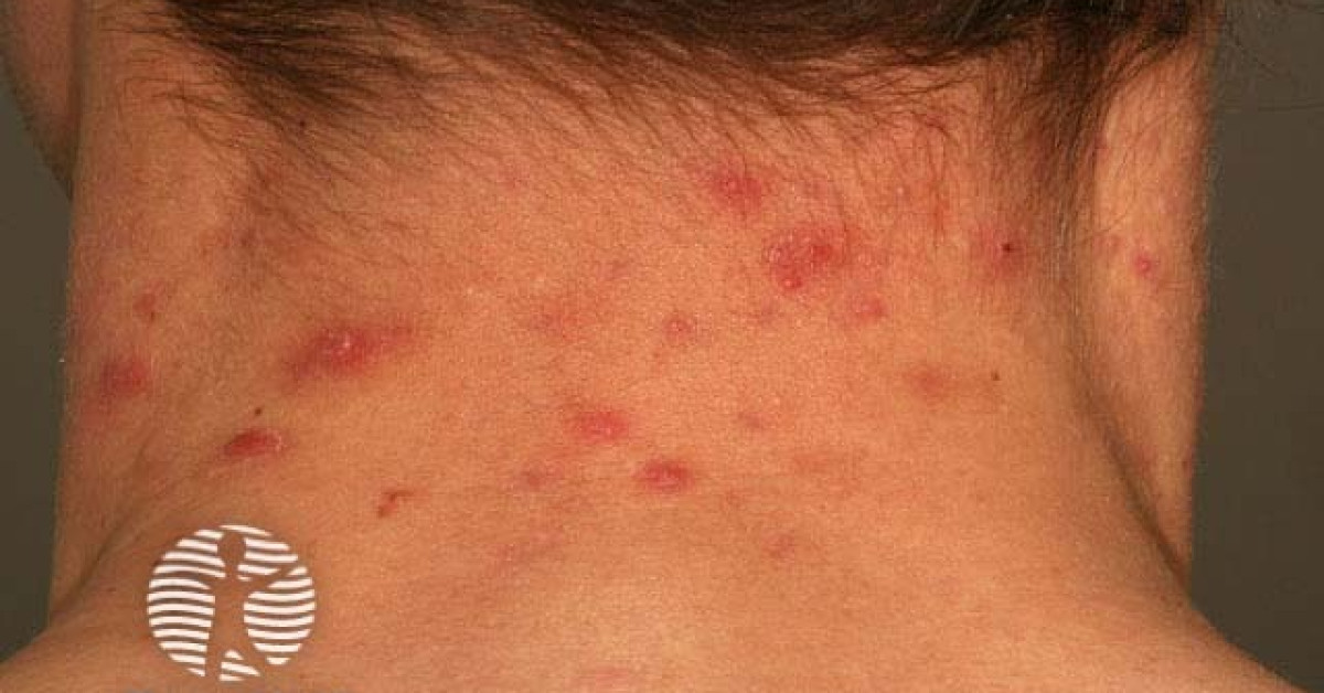 Scalp folliculitis image