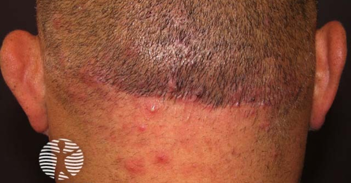 Scalp folliculitis image