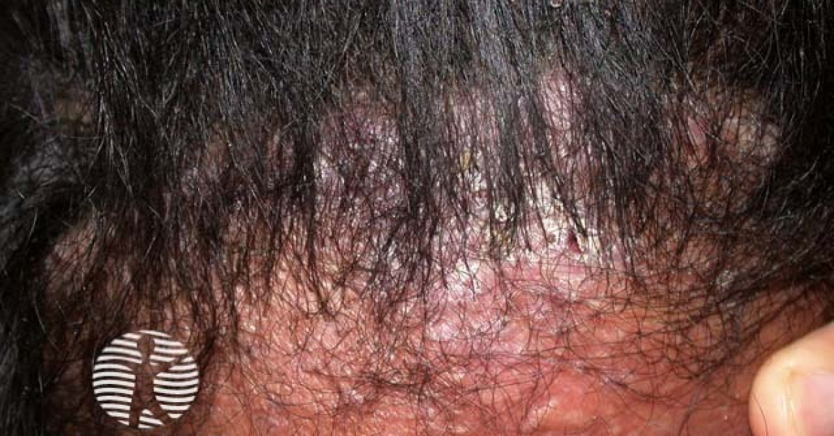 Scalp folliculitis image