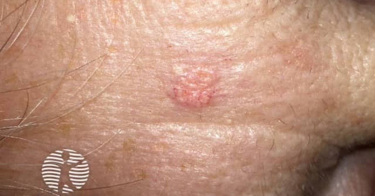 Sebaceous hyperplasia image