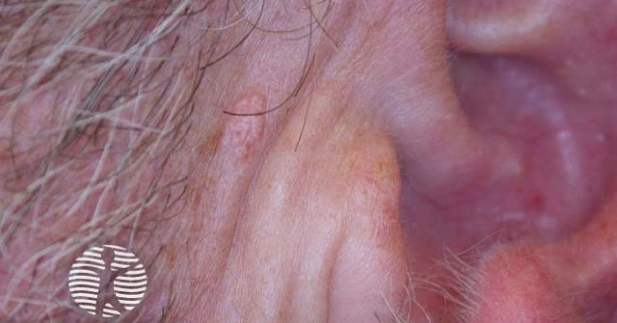Sebaceous hyperplasia image