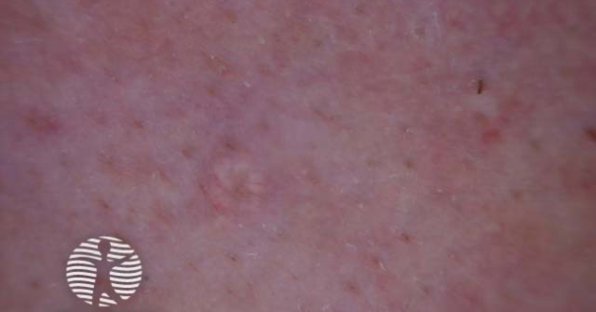 Sebaceous hyperplasia image