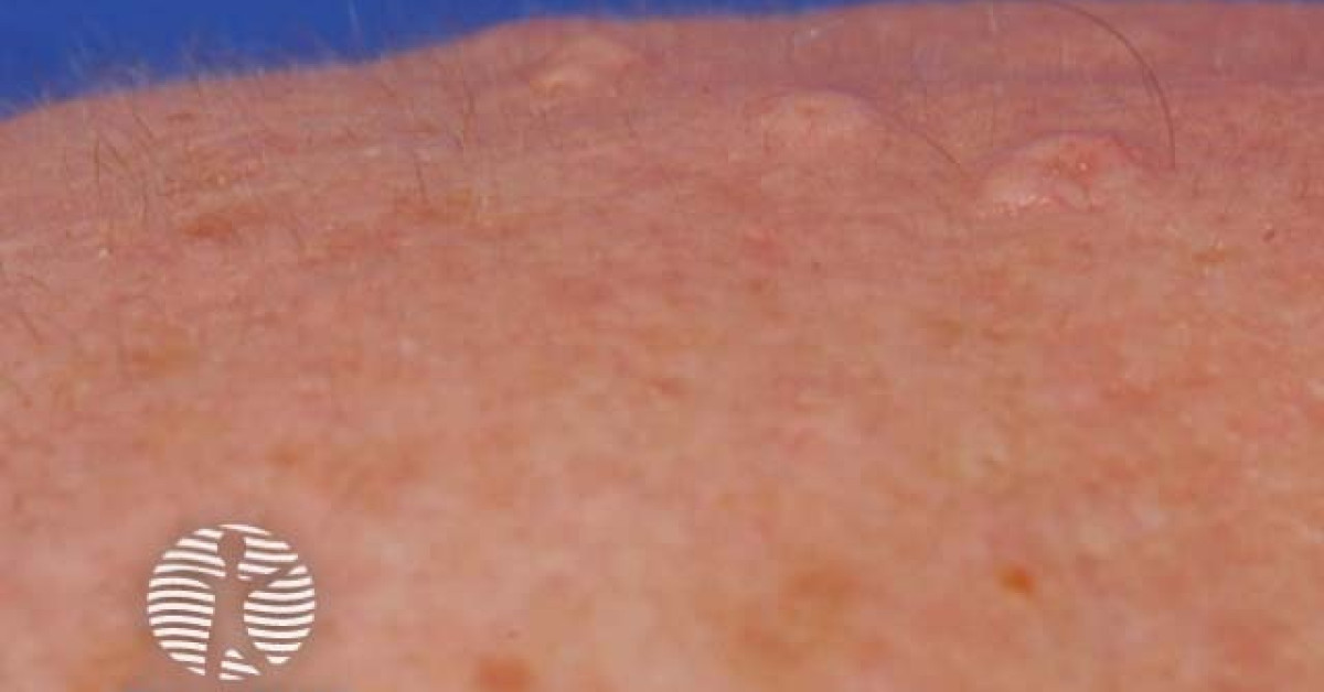 Sebaceous hyperplasia image