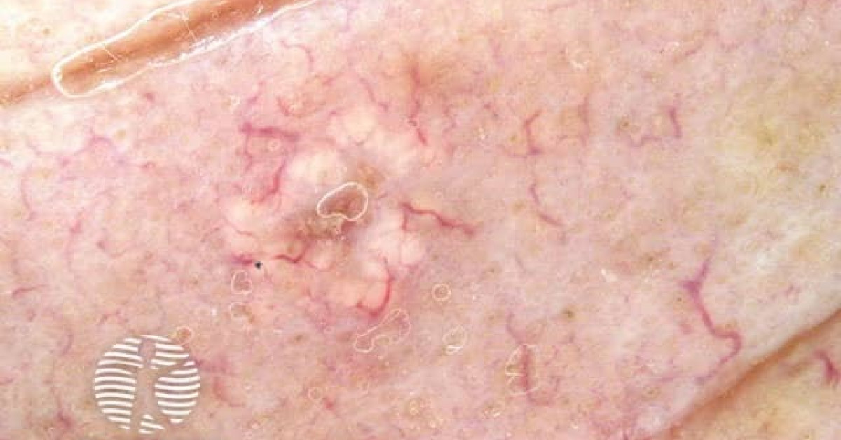 Sebaceous hyperplasia image