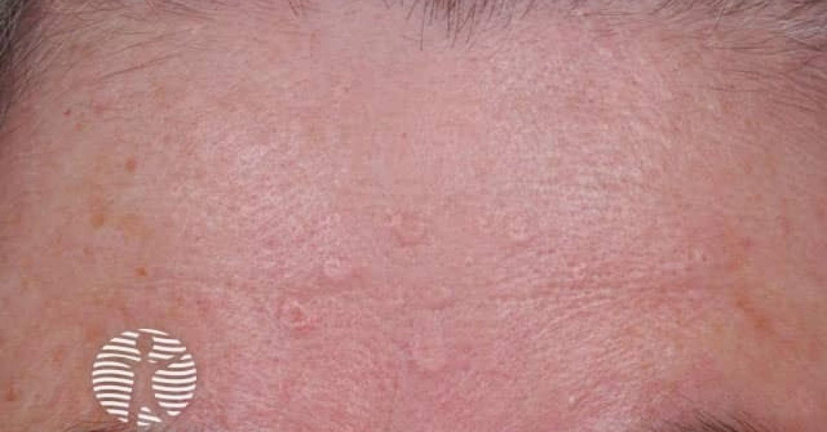 Sebaceous hyperplasia image