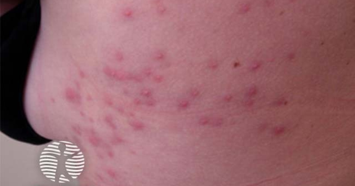 Spa pool folliculitis image