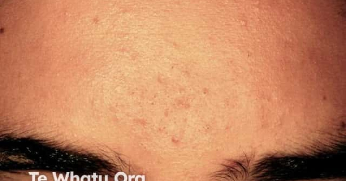 Mild acne vulgaris image