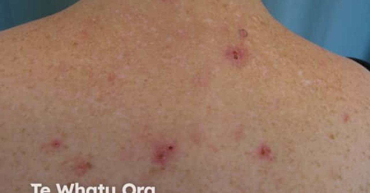 Acne urticata image