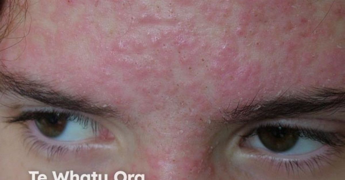 Steroid acne image