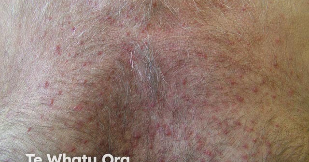 Steroid acne image