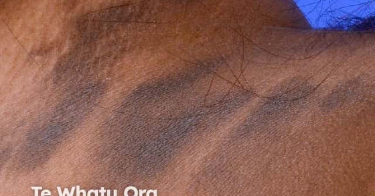 Acquired dermal macular hyperpigmentation image