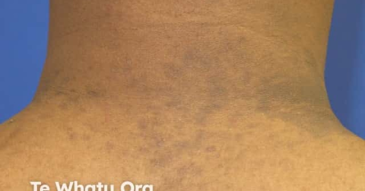 Acquired dermal macular hyperpigmentation image
