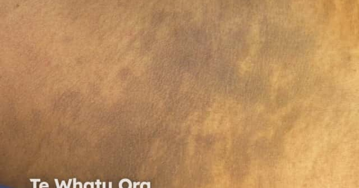 Acquired dermal macular hyperpigmentation image