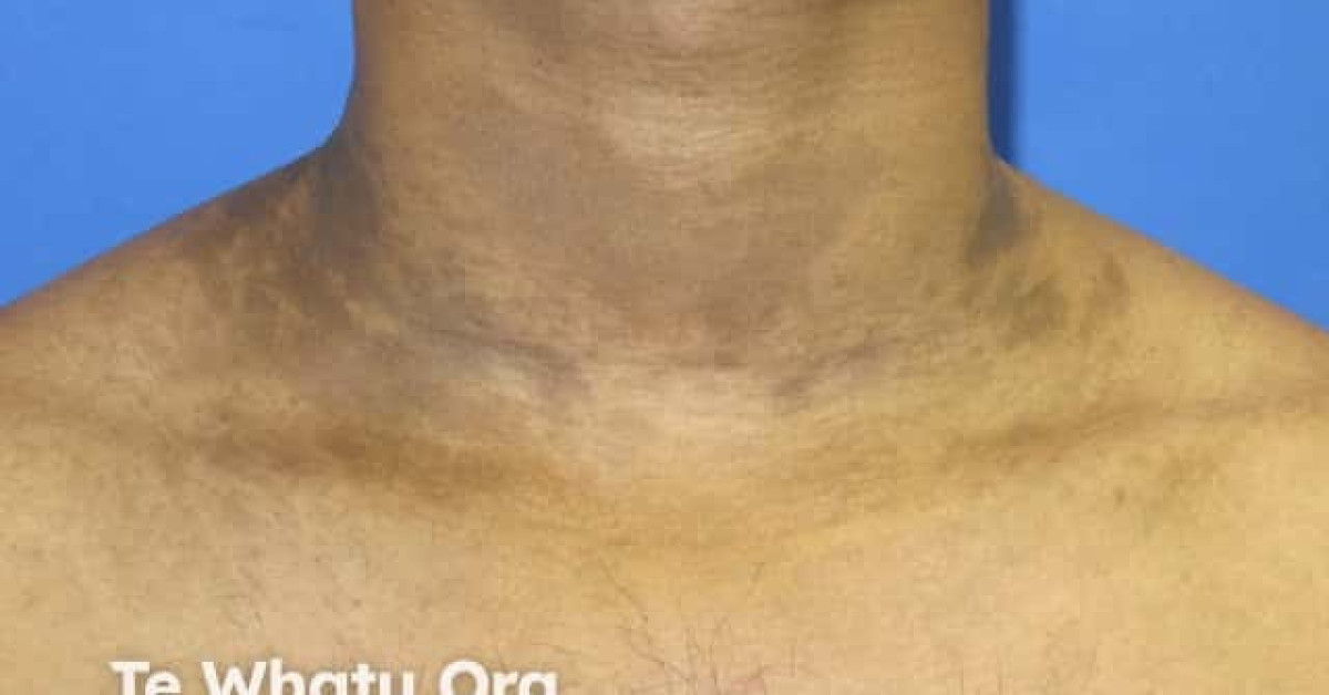 Acquired dermal macular hyperpigmentation image