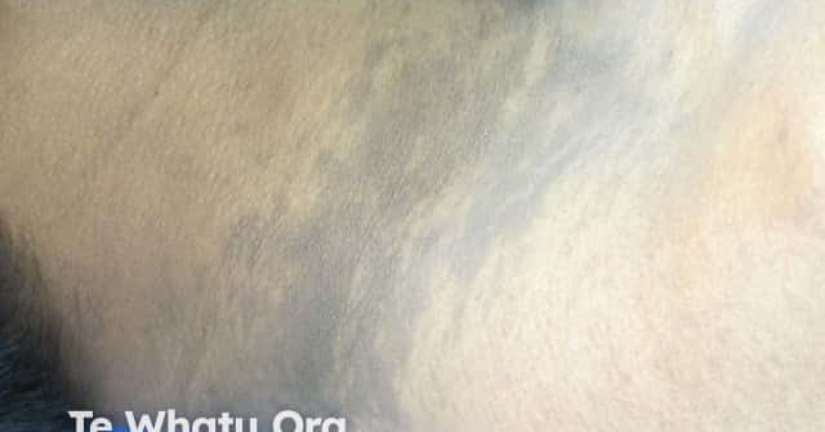 Acquired dermal macular hyperpigmentation image