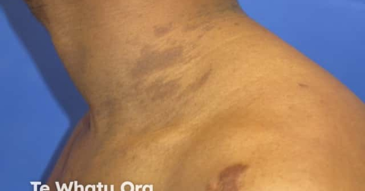 Acquired dermal macular hyperpigmentation image