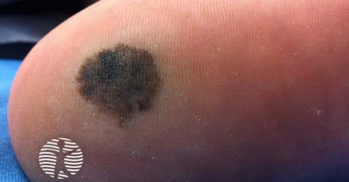 Acral lentiginous melanoma image