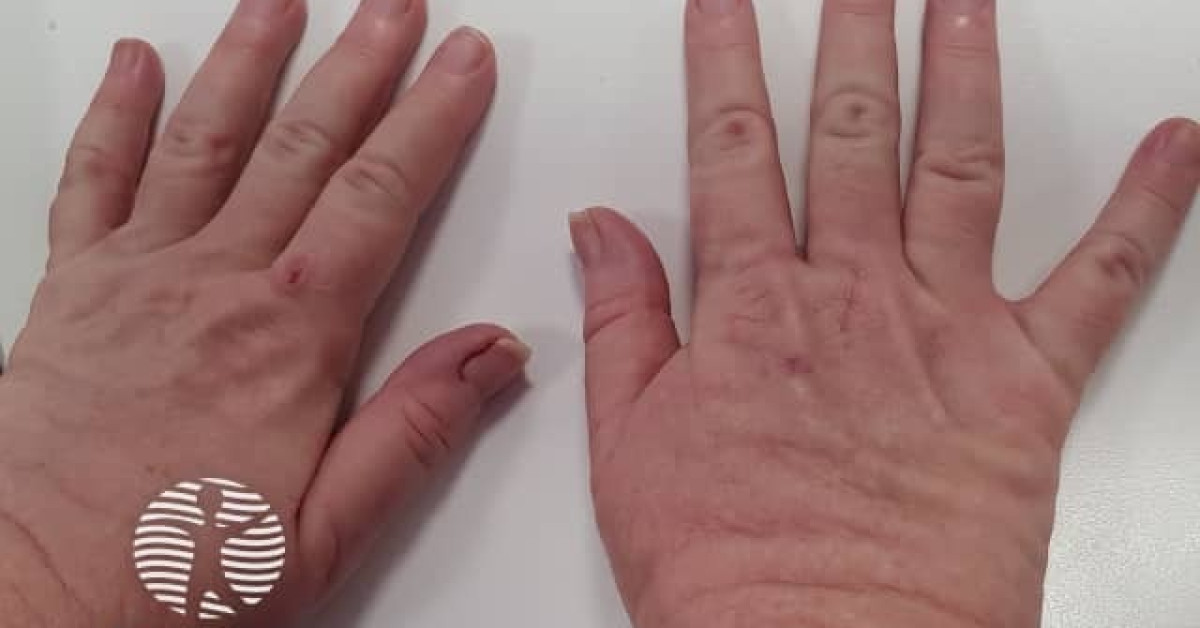 Acral persistent papular mucinosis image