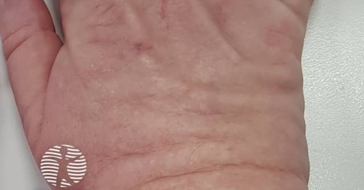 Acral persistent papular mucinosis image