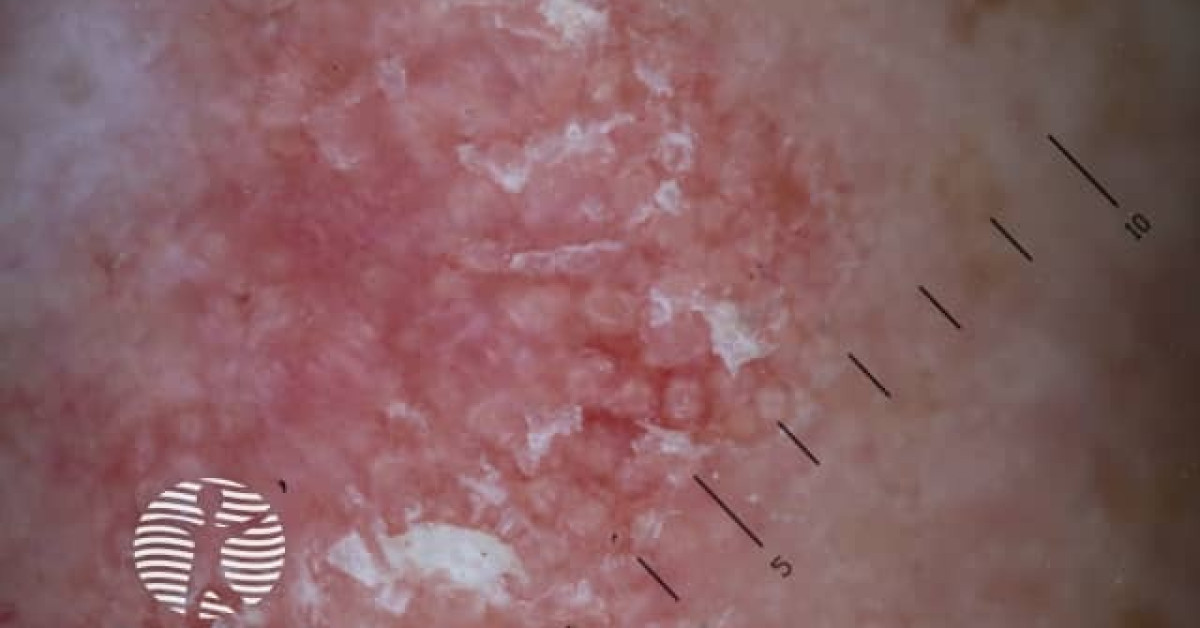 Dermoscopy of actinic keratosis image