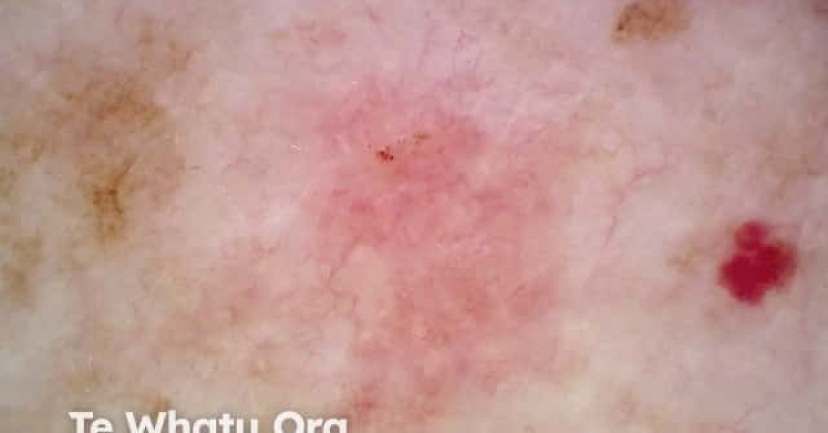 Actinic keratosis on nonfacial skin image