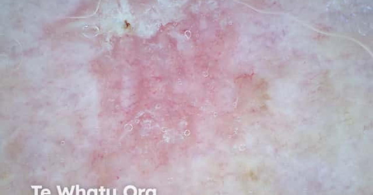 Dermoscopy of actinic keratosis on nonfacial skin image