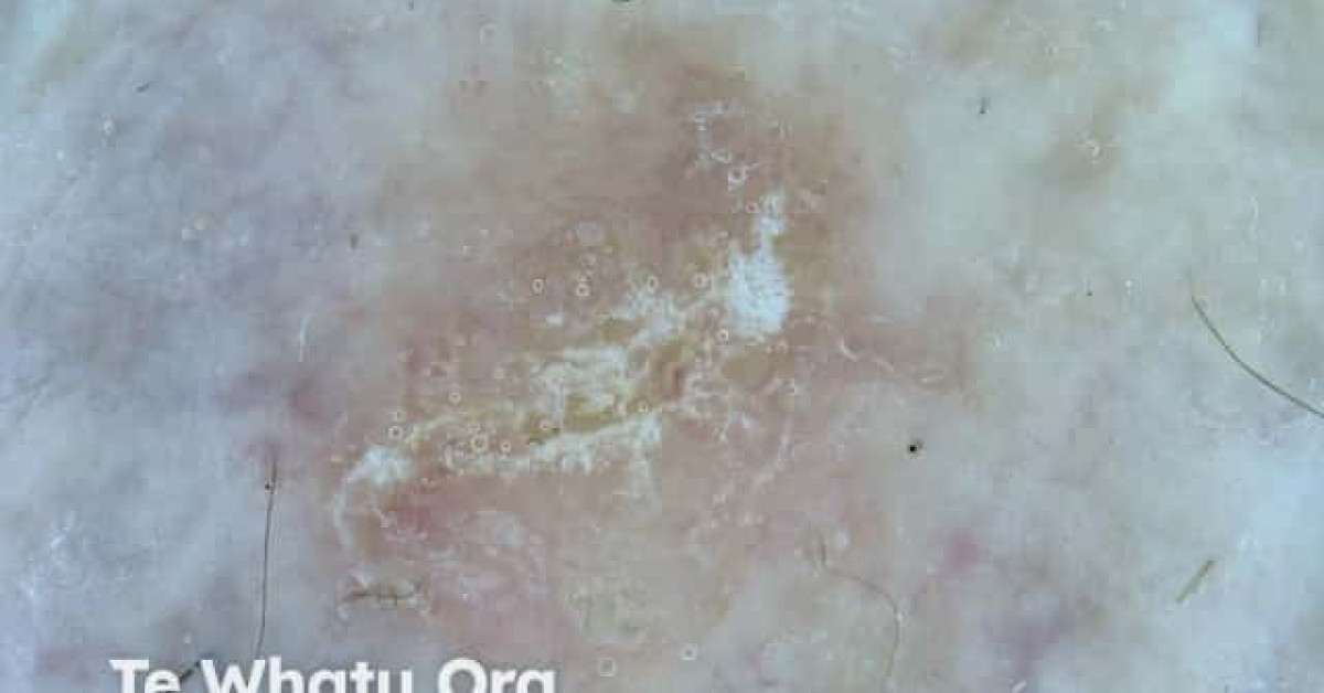 Dermoscopy of actinic keratosis on nonfacial skin image