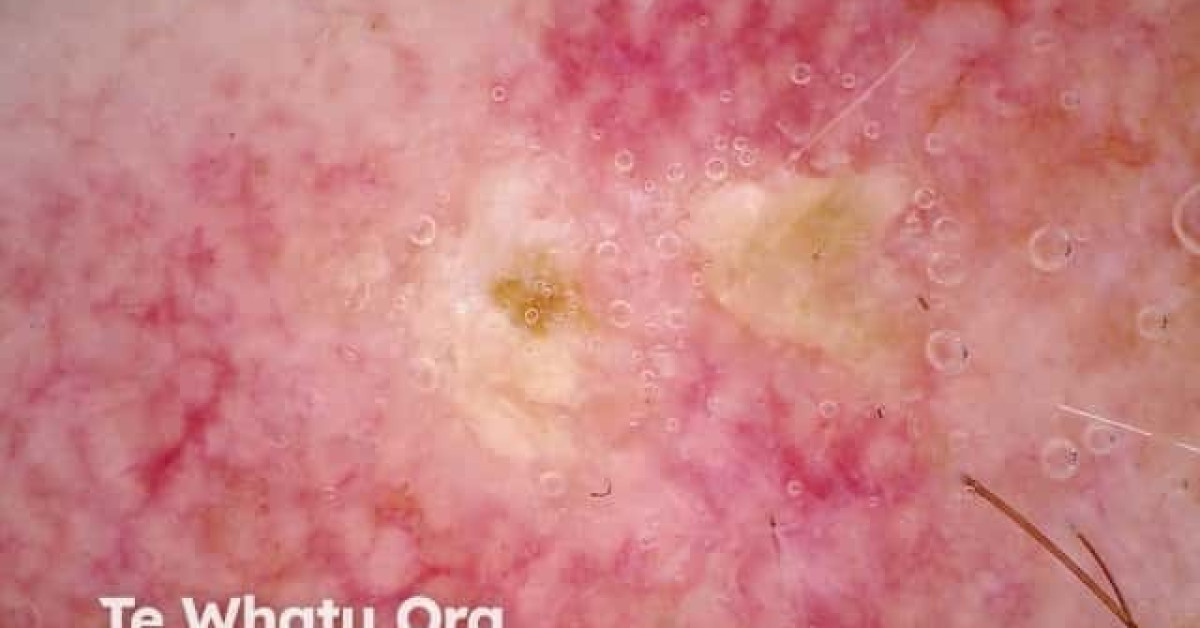 Dermoscopy of actinic keratosis image