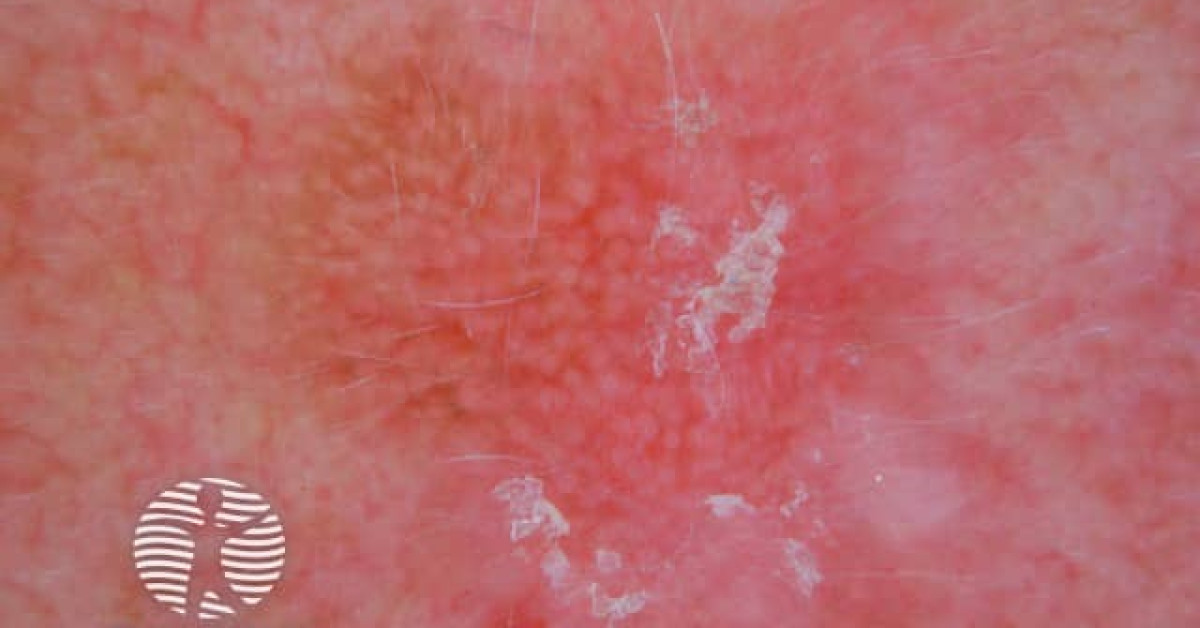 Dermoscopy of actinic keratosis image