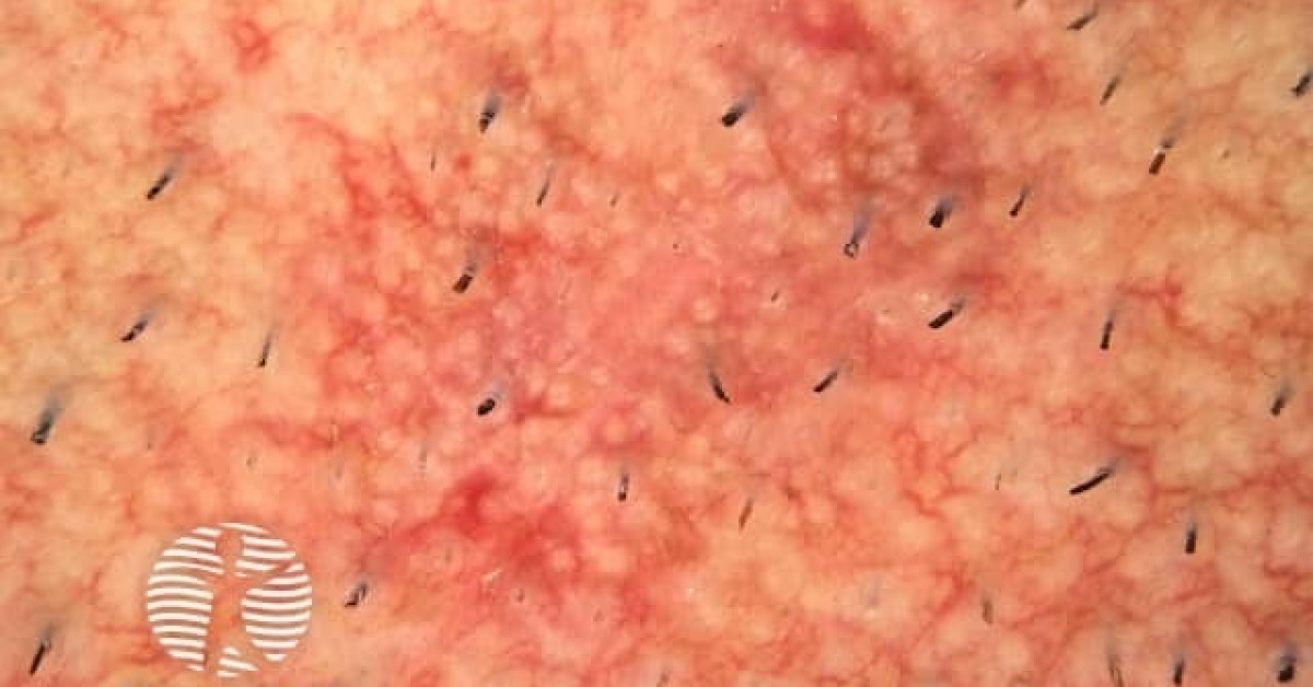 Dermoscopy of actinic keratosis on the face image
