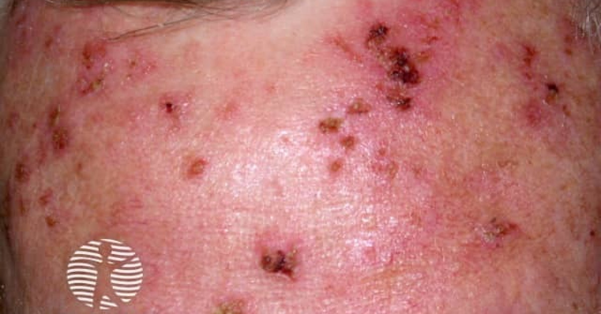 Actinic Keratosis Treated With Fluorouracil Cream Image