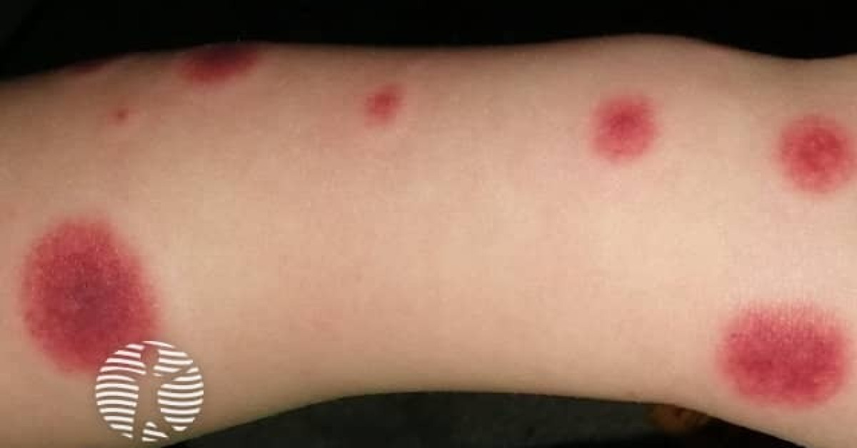 Acute haemorrhagic oedema image