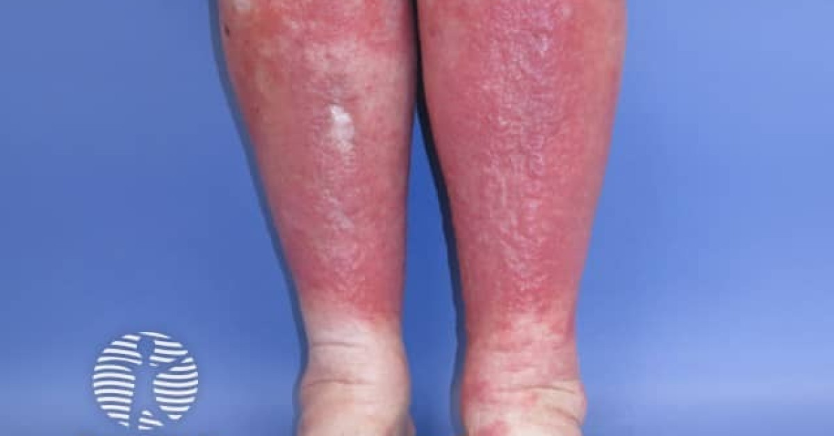 Acute Lipodermatosclerosis Image