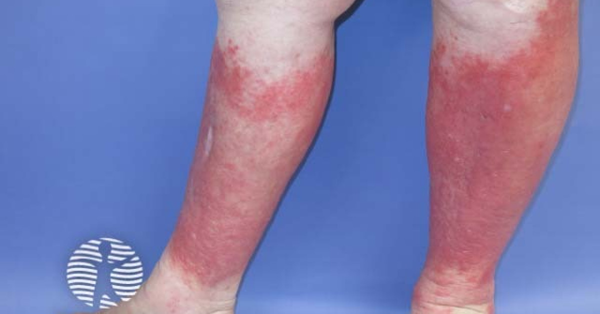 Acute lipodermatosclerosis image