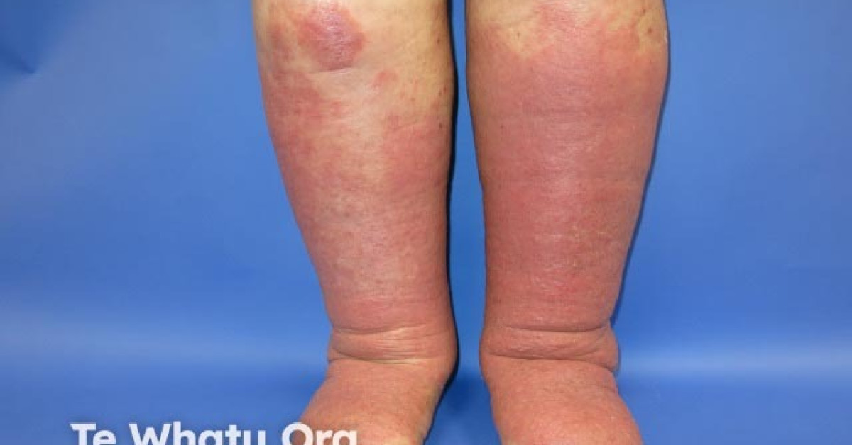 Acute lipodermatosclerosis image