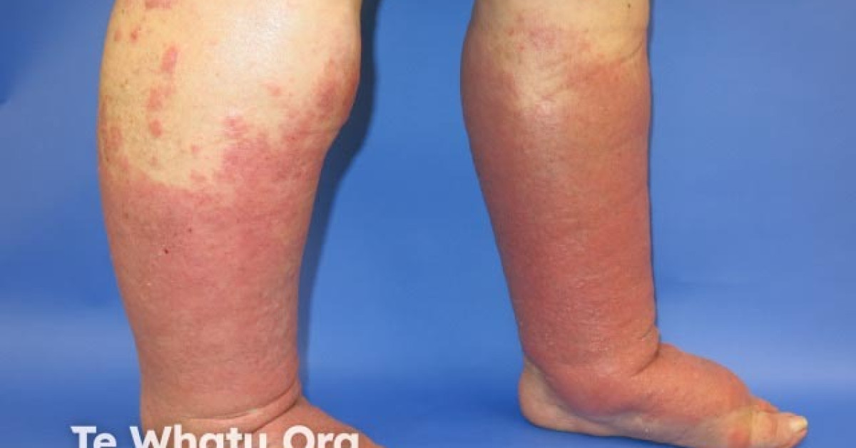 Acute lipodermatosclerosis image