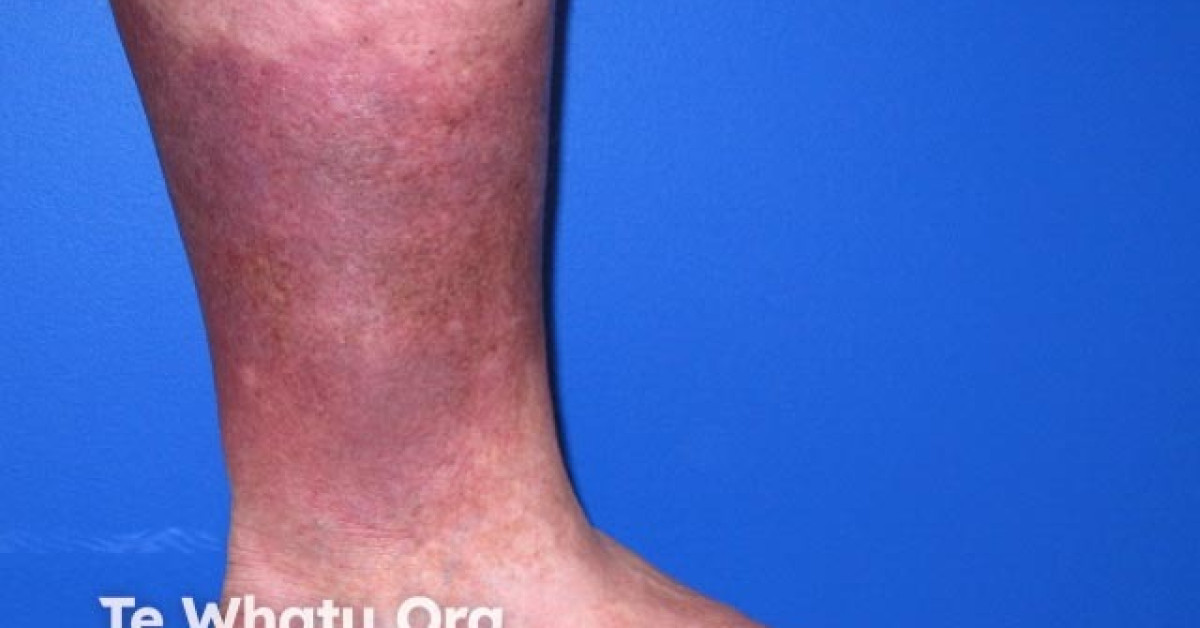 Acute lipodermatosclerosis image