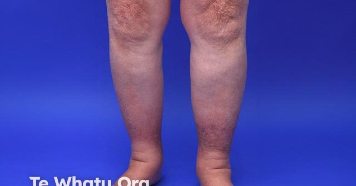 Acute lipodermatosclerosis image