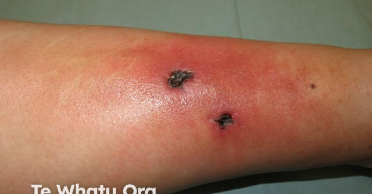 Acute Lipodermatosclerosis Image