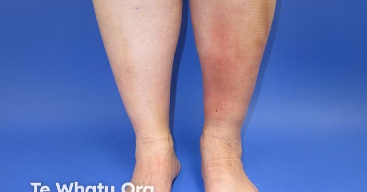 Acute lipodermatosclerosis image