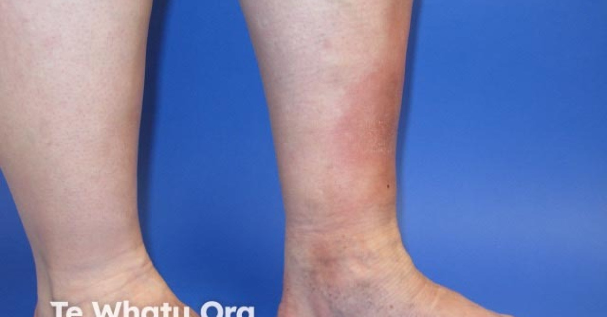 acute lipodermatosclerosis 22 image