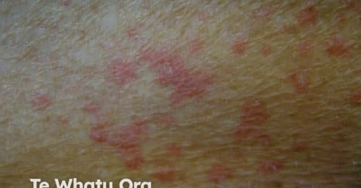 Adult-onset Still disease image