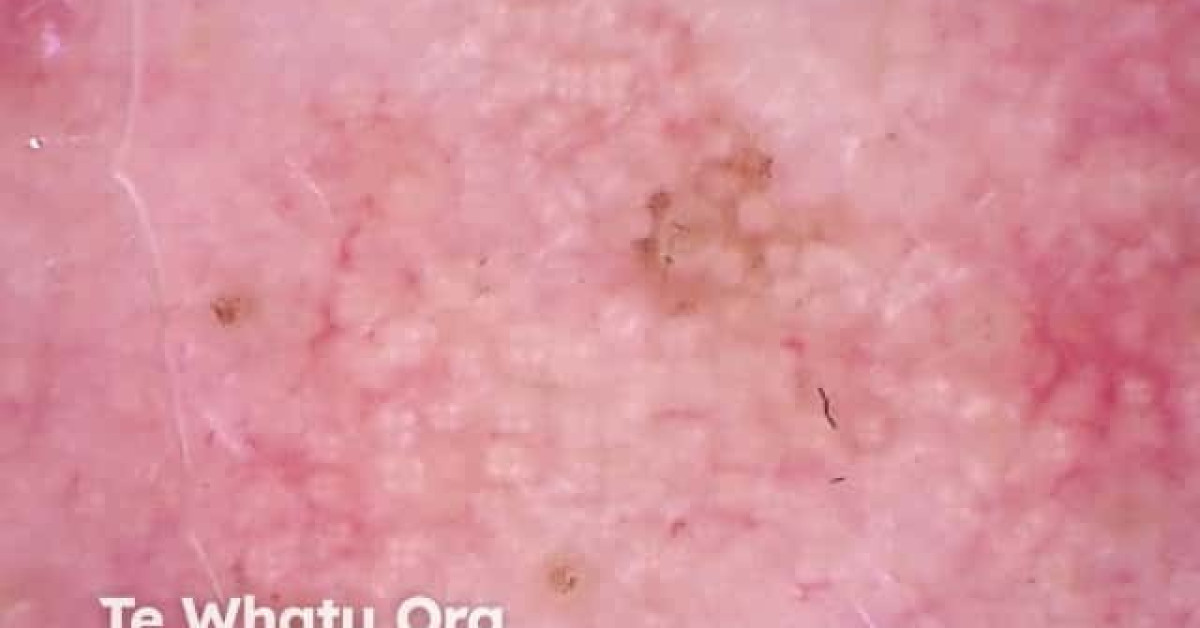 Rosettes in actinic keratosis image