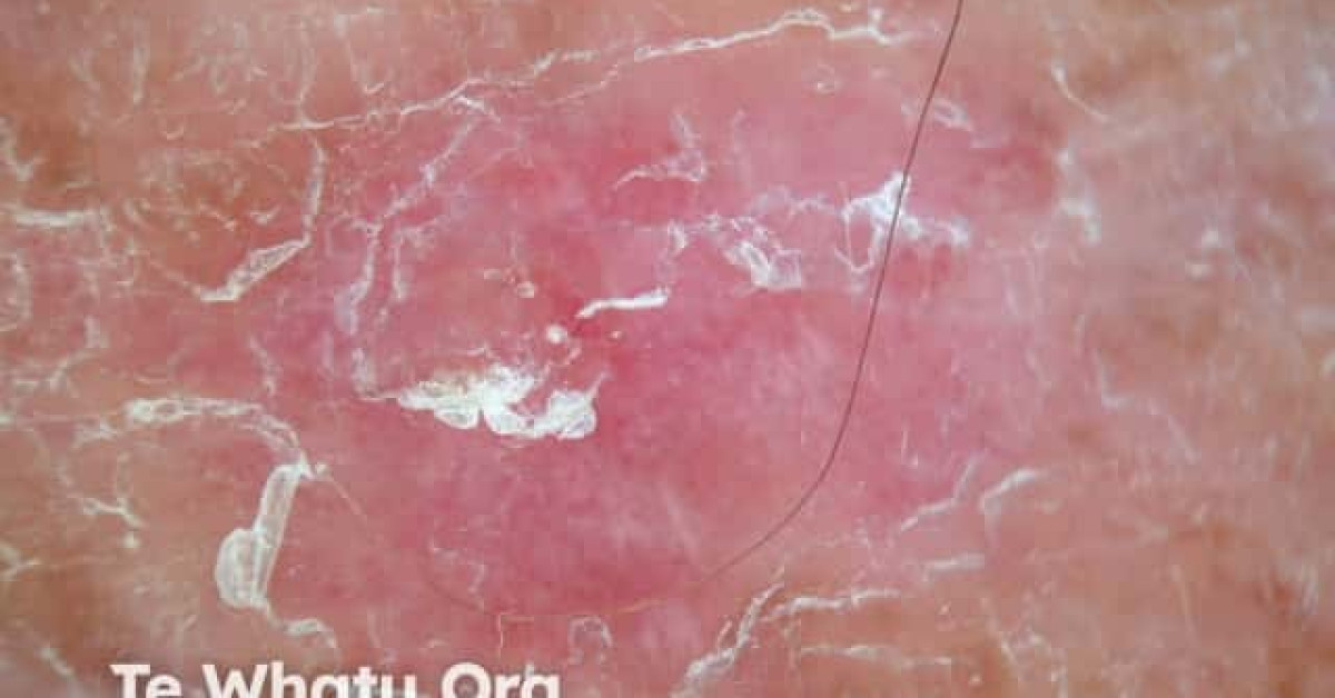 Dermoscopy of actinic keratosis on nonfacial skin image