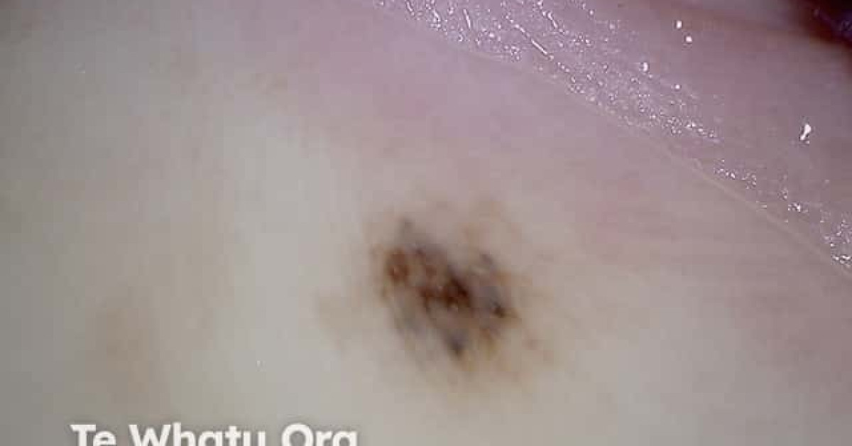 Acral lentiginous melanoma dermoscopy image