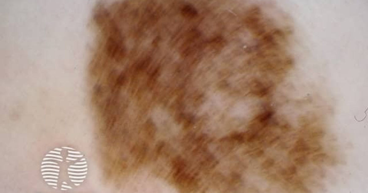 Acral lentiginous melanoma dermoscopy image