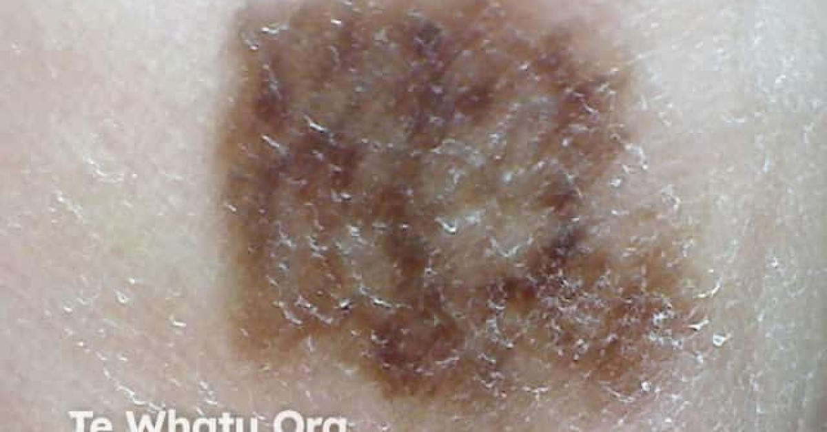 Acral lentiginous melanoma image