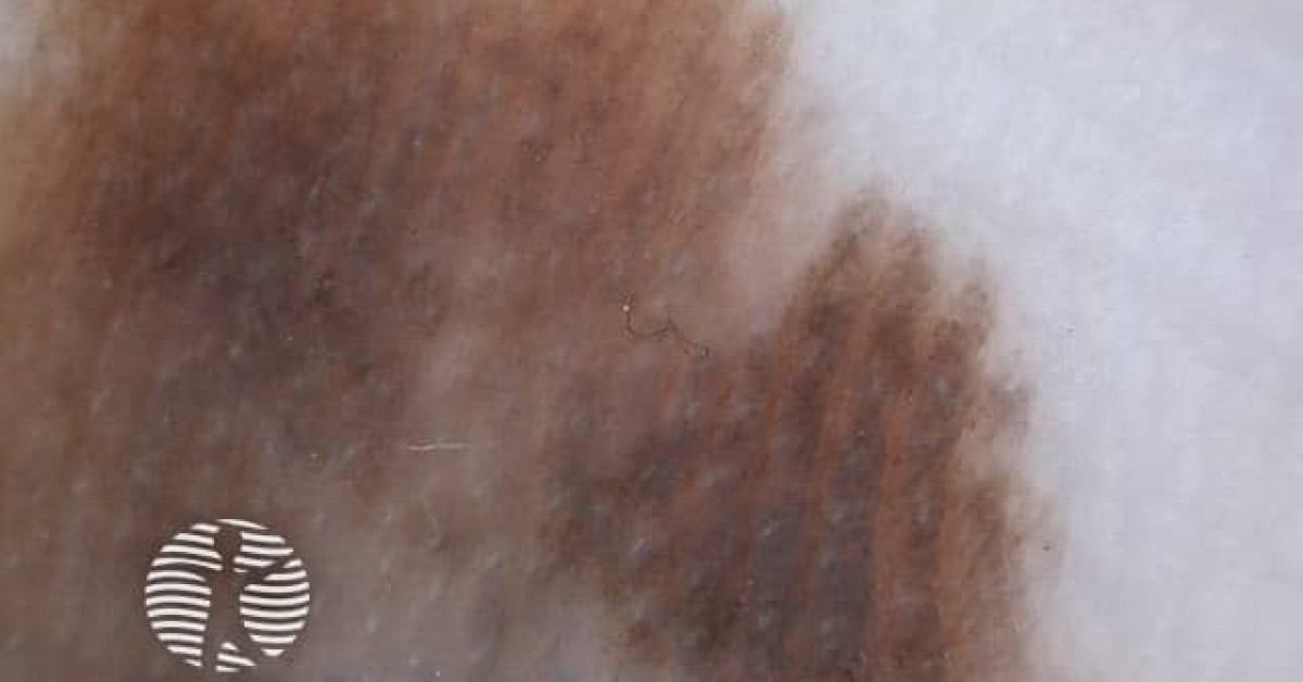 Acral lentiginous melanoma dermoscopy image