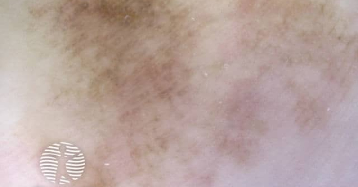 Acral lentiginous melanoma dermoscopy image