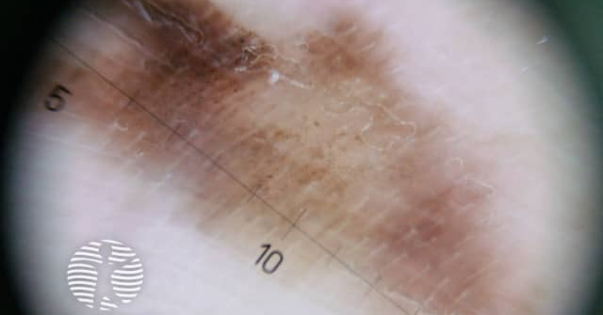 Acral lentiginous melanoma dermoscopy image